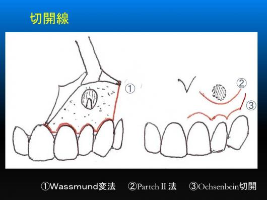 歯根端切除術の術式
